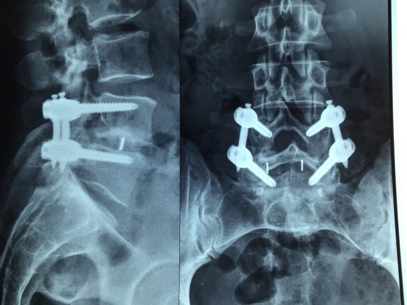 Artrodese Da Coluna Lombar ( Minimamente Invasiva – Mip) – IOT Coluna ...