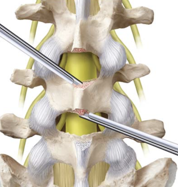 Estenose lombar do canal vertebral – IOT Coluna – Passo Fundo/RS